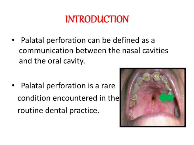 Perforation of palate | PPTX