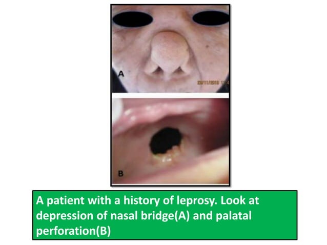 Perforation of palate | PPTX