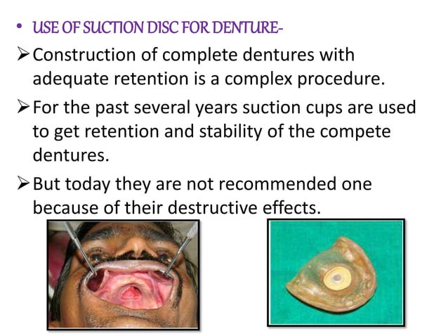 Perforation of palate | PPTX