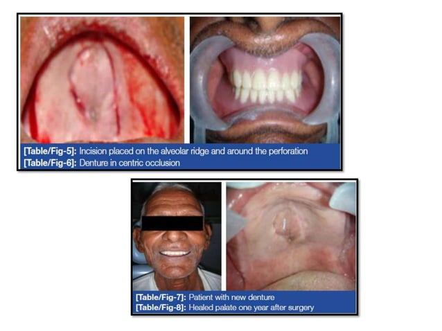 Perforation of palate | PPTX