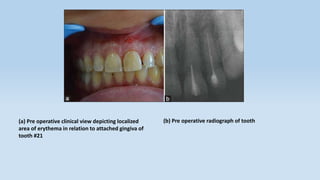 Perforations 3 | PPTX