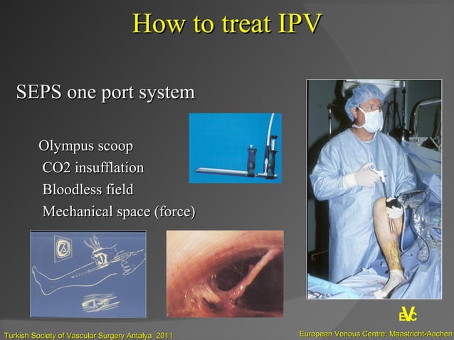 Perforator veins why and how to treat them | PPT | Blood Disorders ...