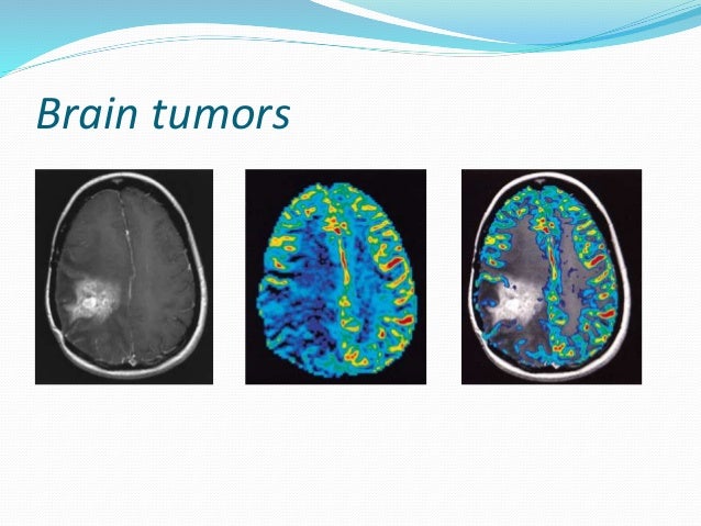 Perfusion and dynamic contrast enhanced mri