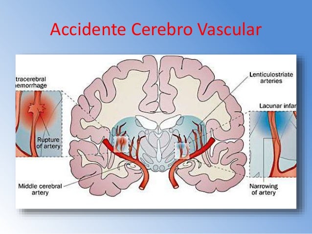 Perfusion cerebral EN TC