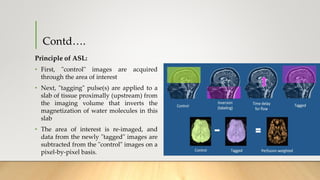 Perfusion imaging: CT, MRI, Nuclear Medicine- Avinesh Shrestha | PPTX