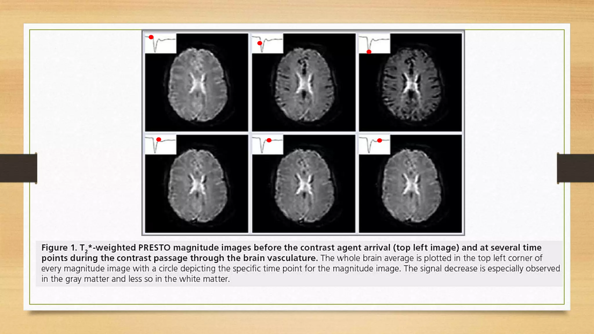 Perfusion MRI (DSC and DCE perfusion techniques) for radiology residents | PDF