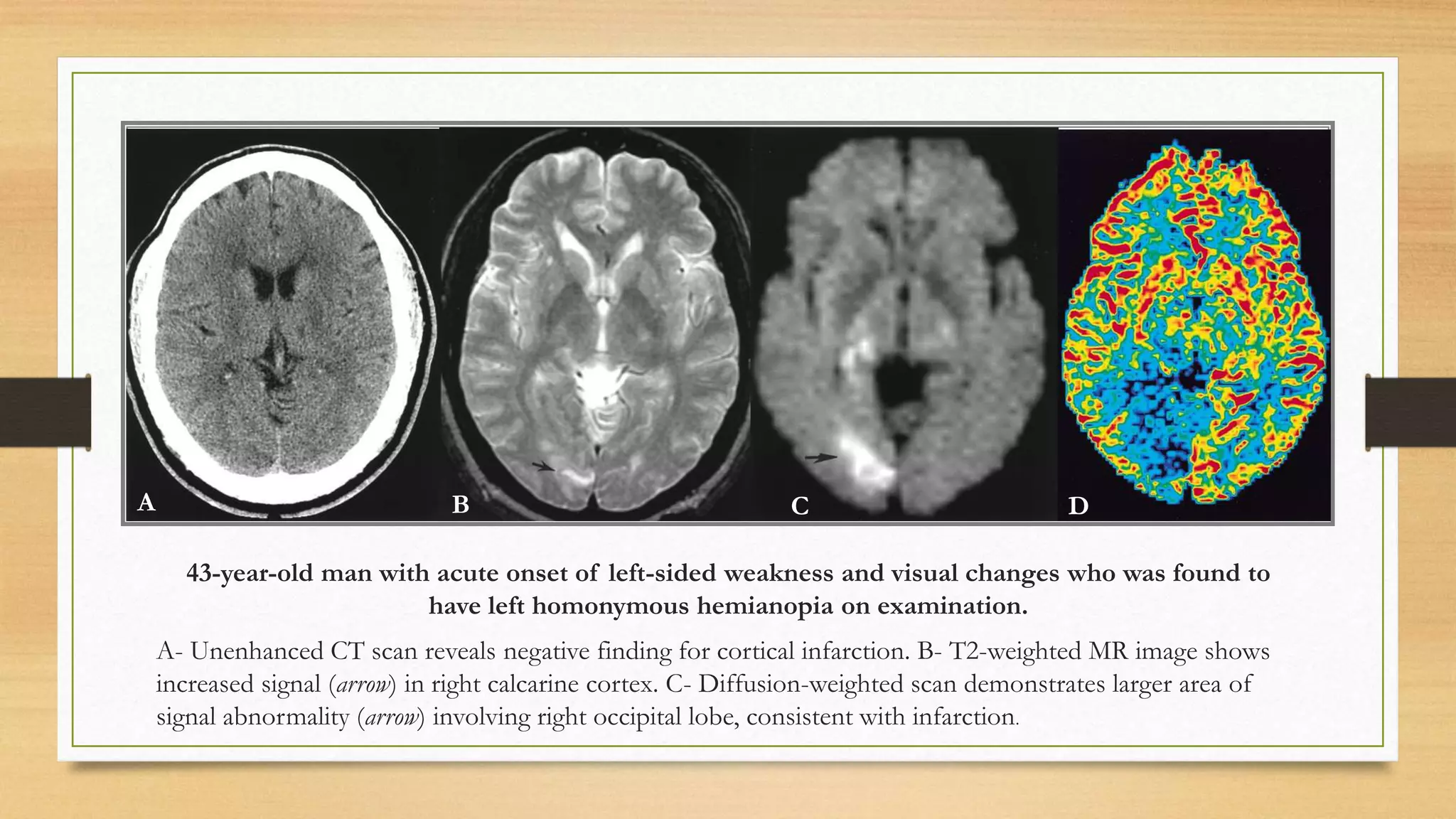 Perfusion MRI (DSC and DCE perfusion techniques) for radiology residents | PDF