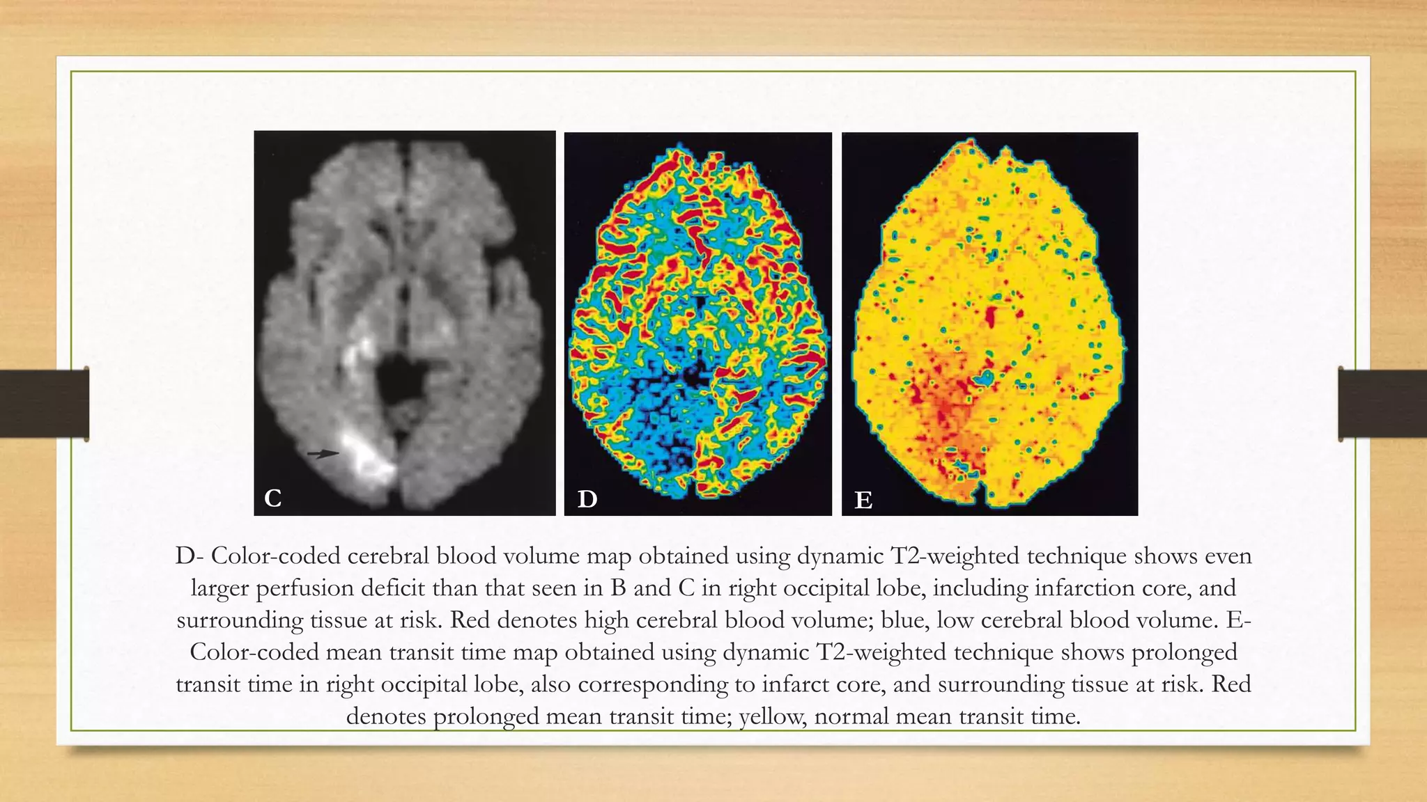 Perfusion MRI (DSC and DCE perfusion techniques) for radiology residents | PDF
