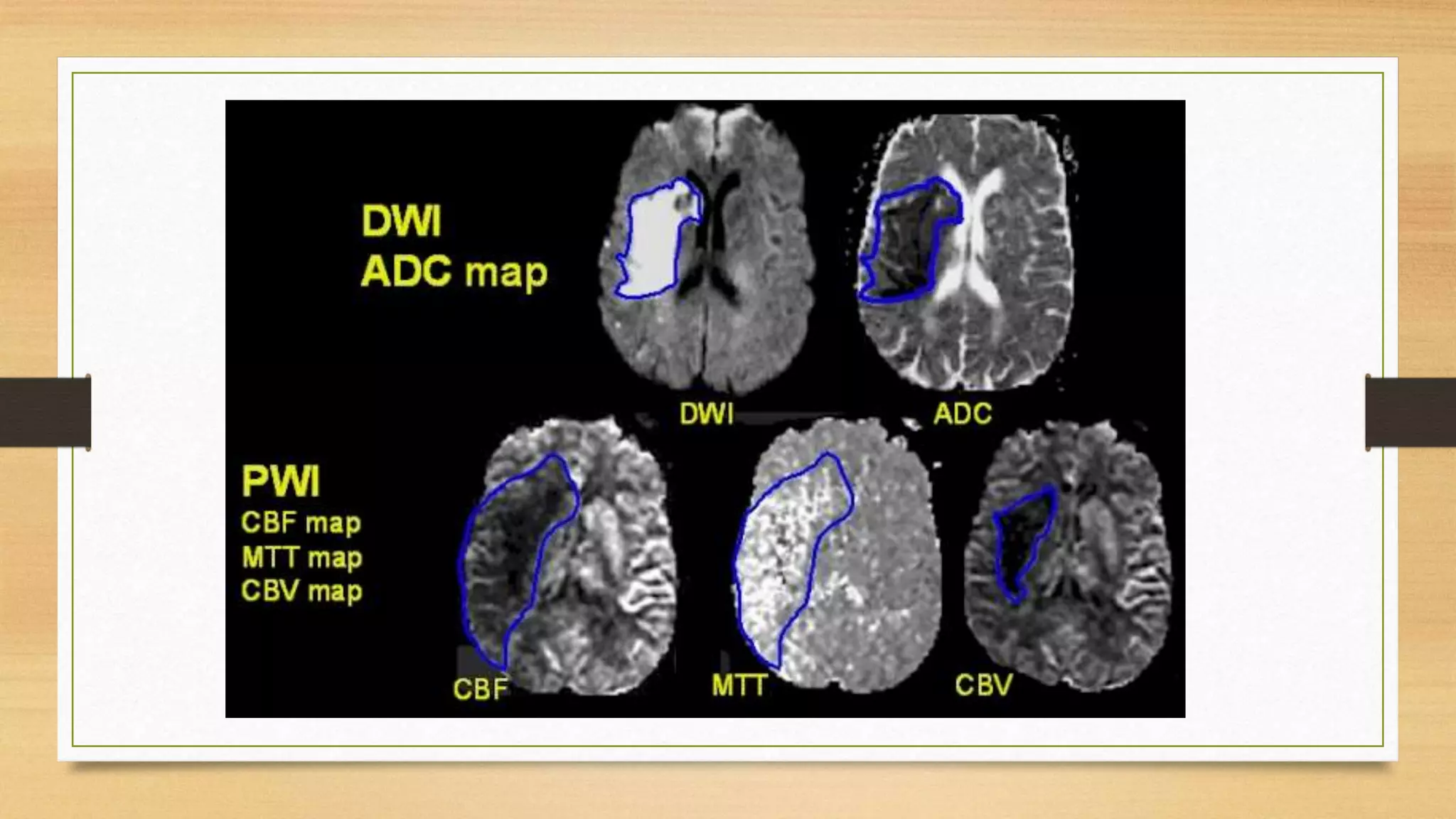 Perfusion MRI (DSC and DCE perfusion techniques) for radiology residents | PDF