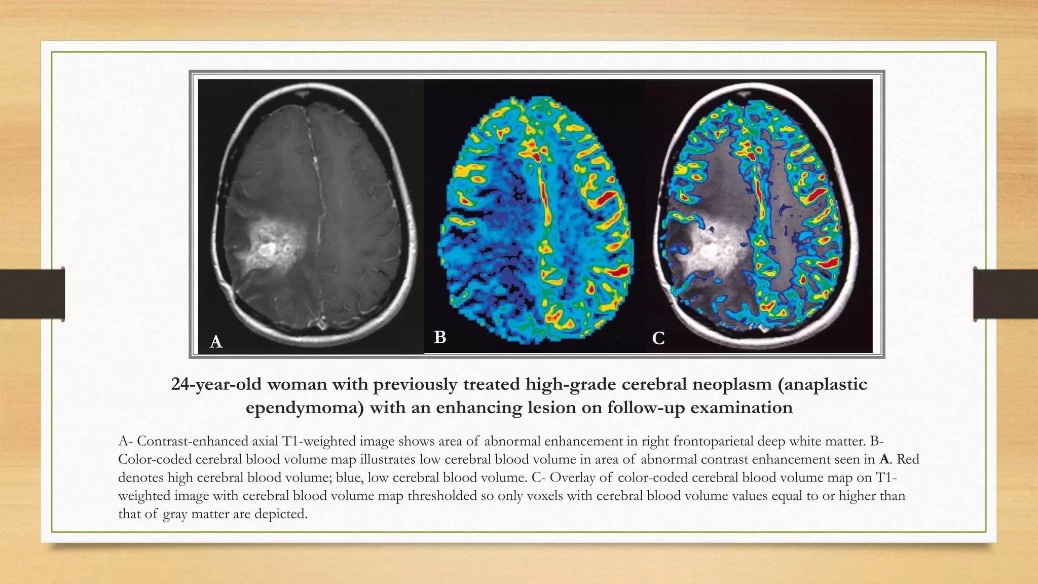 Perfusion MRI (DSC and DCE perfusion techniques) for radiology ...