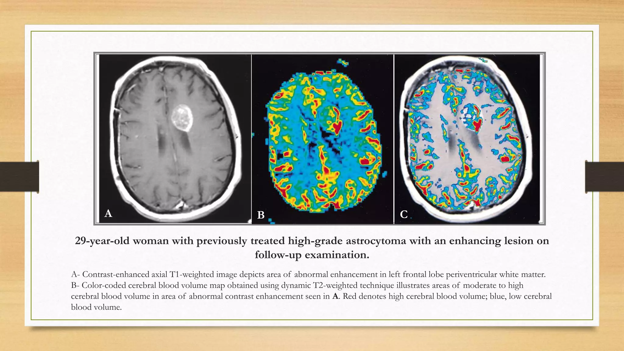 Perfusion MRI (DSC and DCE perfusion techniques) for radiology ...