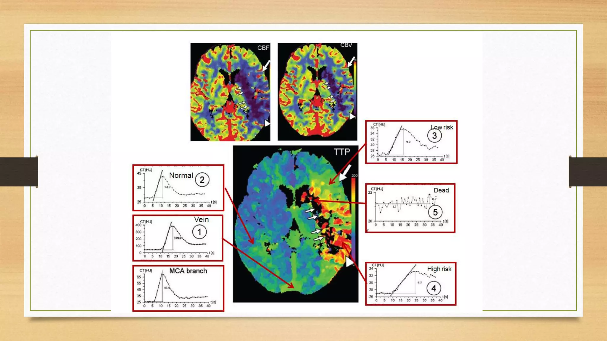 Perfusion MRI (DSC and DCE perfusion techniques) for radiology ...