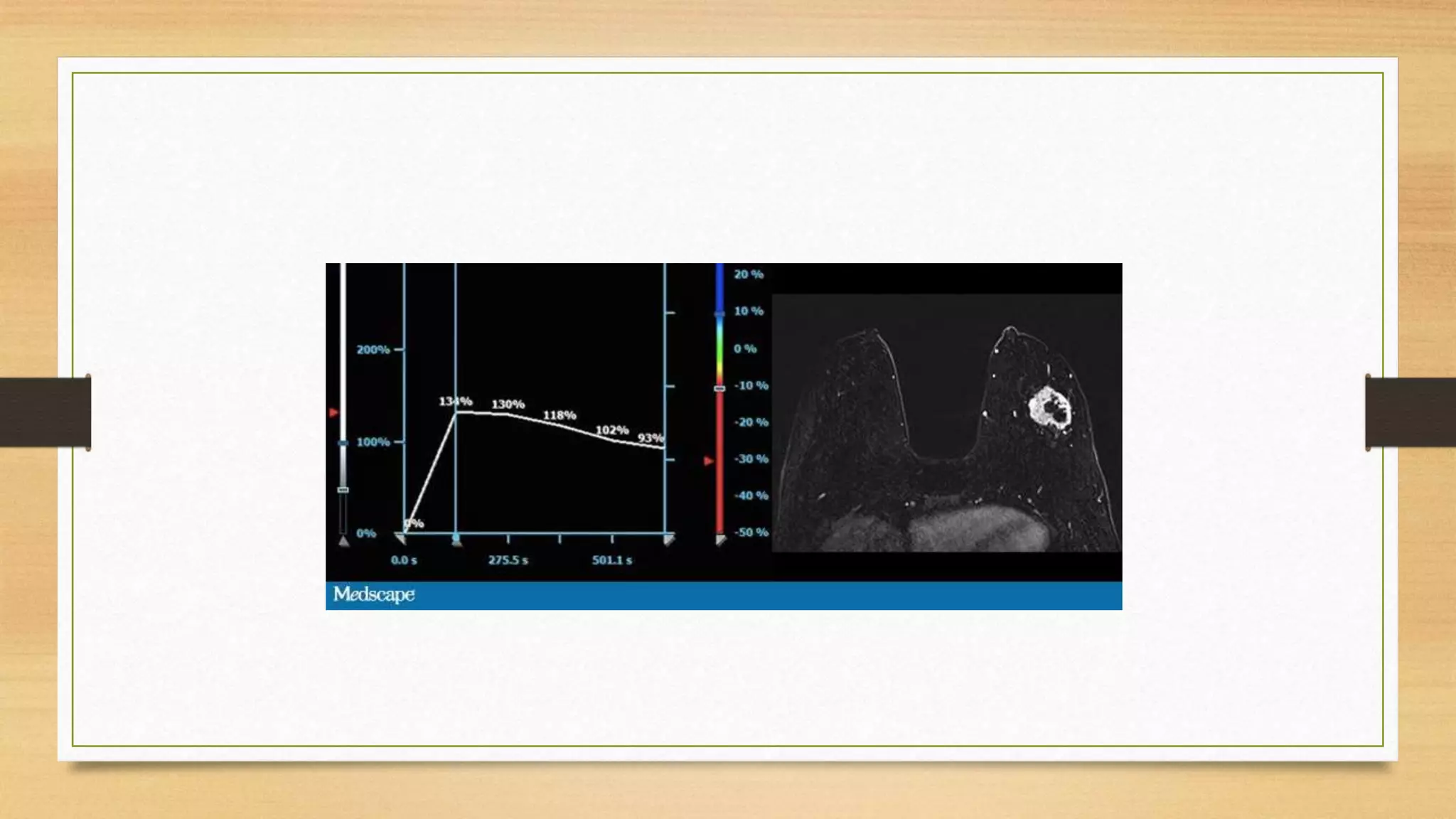 Perfusion MRI (DSC and DCE perfusion techniques) for radiology ...