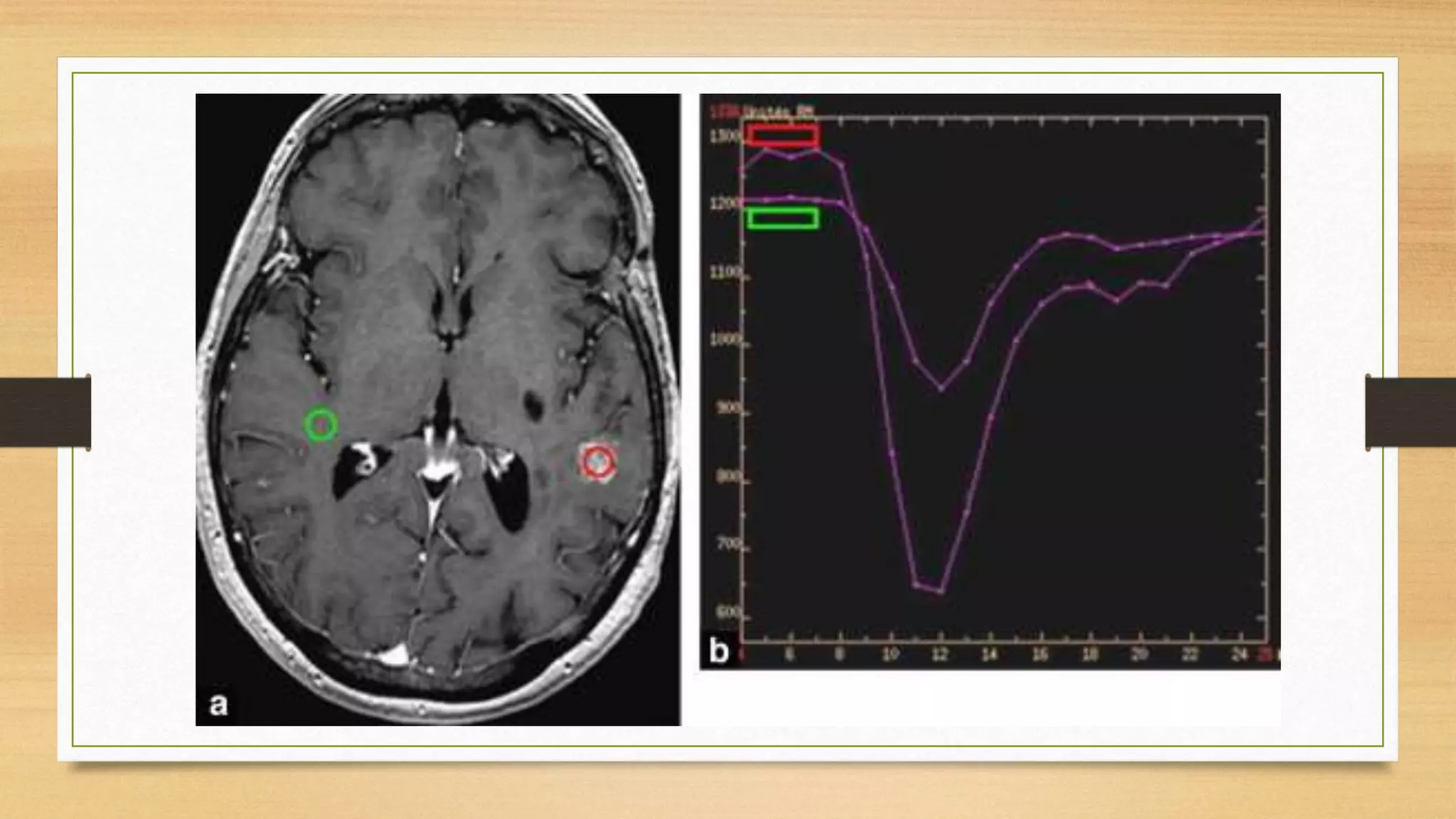 Perfusion MRI (DSC and DCE perfusion techniques) for radiology ...