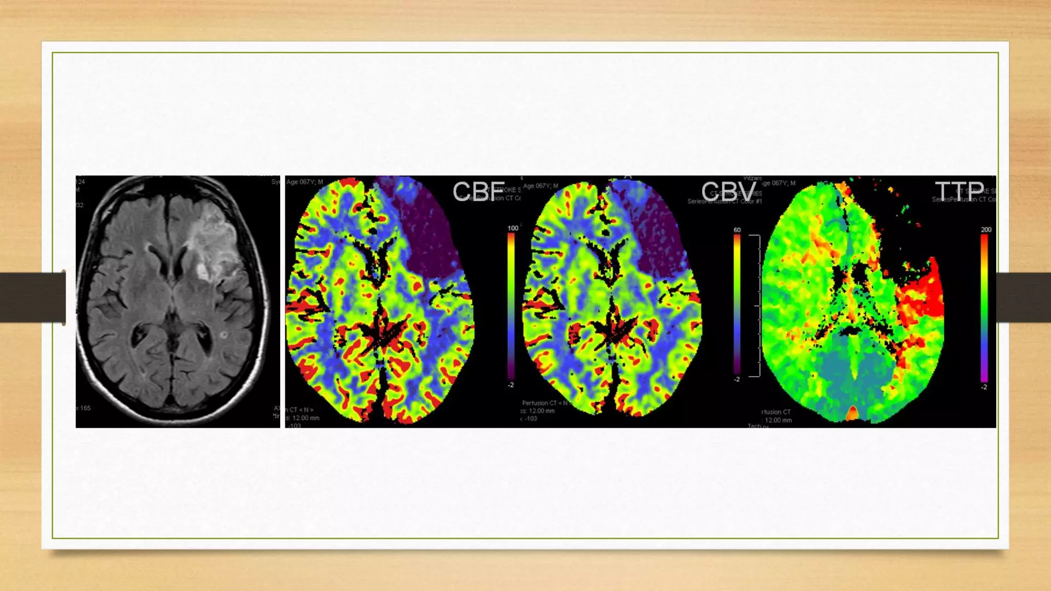 Perfusion MRI (DSC and DCE perfusion techniques) for radiology ...