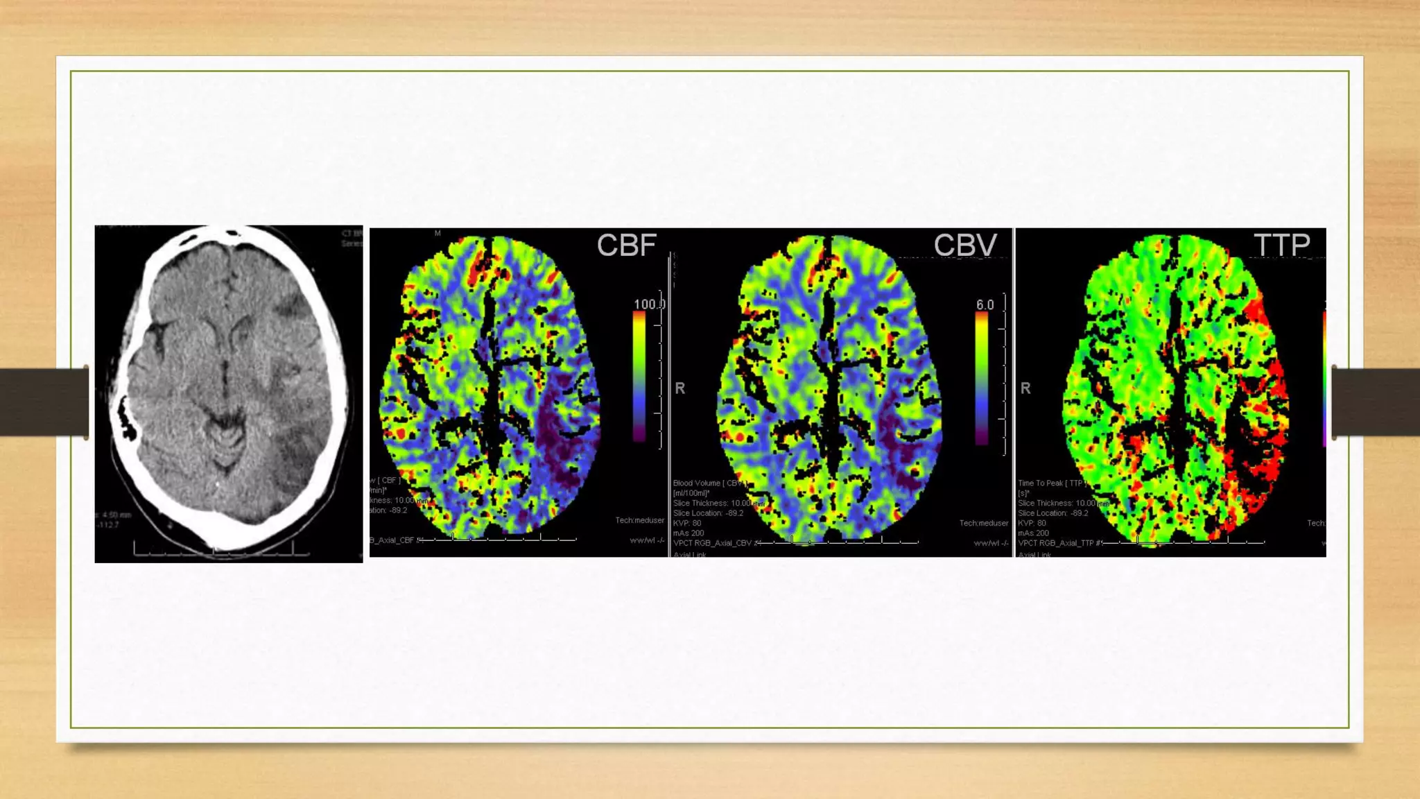Perfusion MRI (DSC and DCE perfusion techniques) for radiology ...