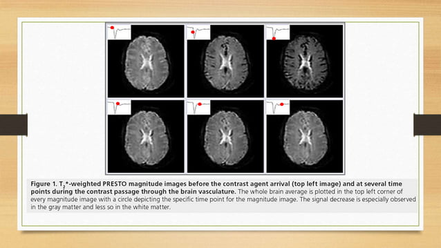 Perfusion MRI (DSC and DCE perfusion techniques) for radiology residents | PDF | Brain and ...