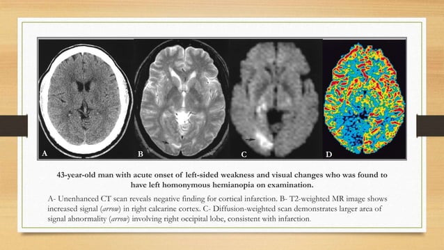 Perfusion MRI (DSC and DCE perfusion techniques) for radiology ...
