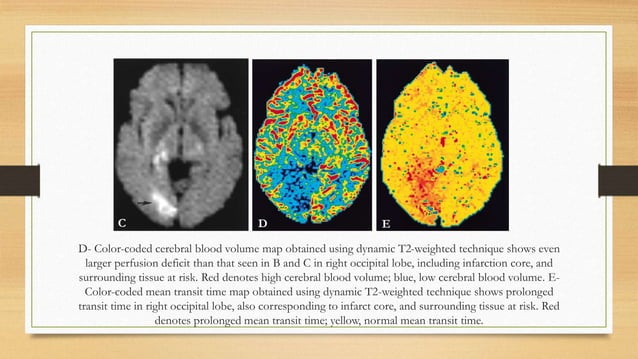 Perfusion MRI (DSC and DCE perfusion techniques) for radiology ...