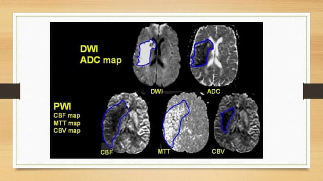 Perfusion MRI (DSC and DCE perfusion techniques) for radiology residents | PDF | Brain and ...