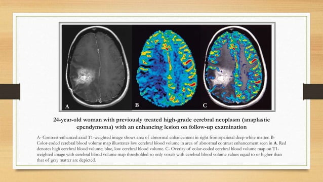 Perfusion MRI (DSC and DCE perfusion techniques) for radiology ...