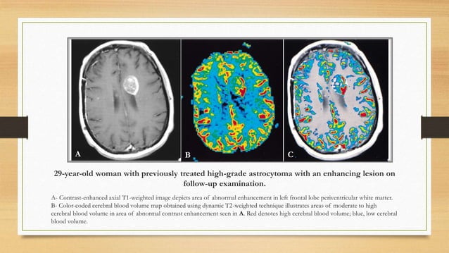 Perfusion MRI (DSC and DCE perfusion techniques) for radiology ...