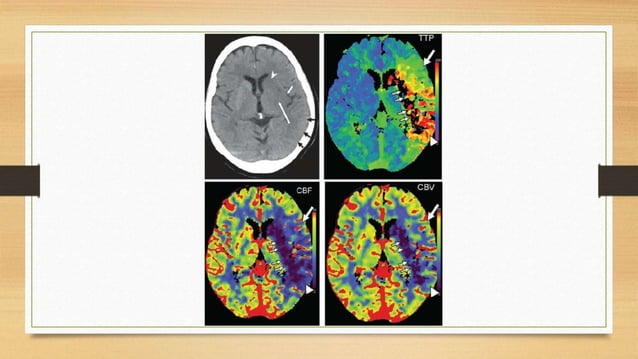 Perfusion MRI (DSC and DCE perfusion techniques) for radiology ...