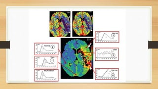 Perfusion MRI (DSC and DCE perfusion techniques) for radiology ...