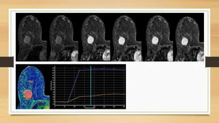 Perfusion MRI (DSC and DCE perfusion techniques) for radiology ...