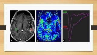 Perfusion MRI (DSC and DCE perfusion techniques) for radiology ...