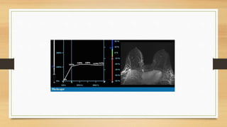 Perfusion MRI (DSC and DCE perfusion techniques) for radiology ...