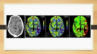 Perfusion MRI (DSC and DCE perfusion techniques) for radiology ...