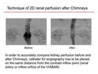 Renal Perfusion after EVAR: functional assessment with 2D perfusion ...