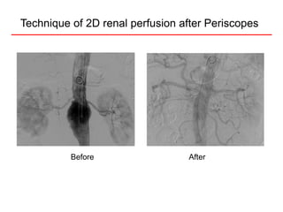 Renal Perfusion after EVAR: functional assessment with 2D perfusion measurements | PPT