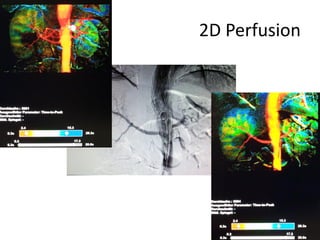 Renal Perfusion after EVAR: functional assessment with 2D perfusion measurements | PPT