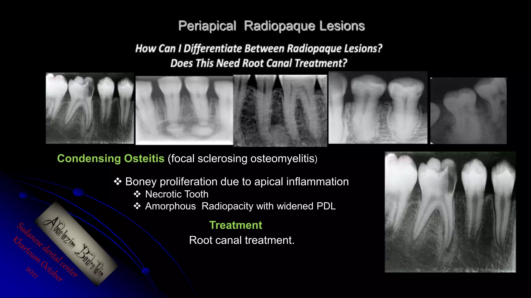 Peri apical radiolucency | PPTX
