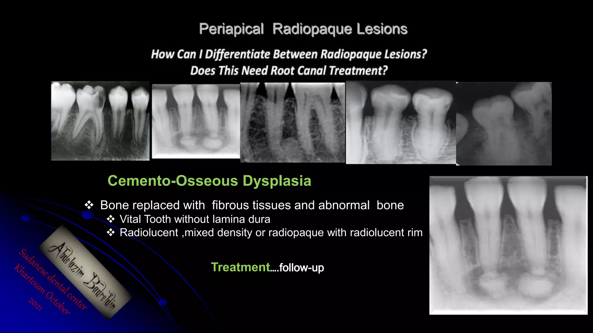 Peri apical radiolucency | PPTX