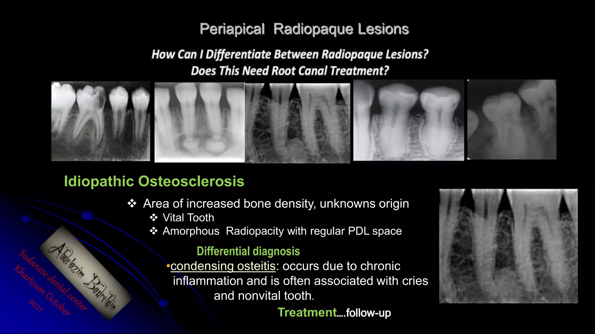 Peri apical radiolucency | PPTX