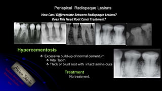Peri apical radiolucency | PPT