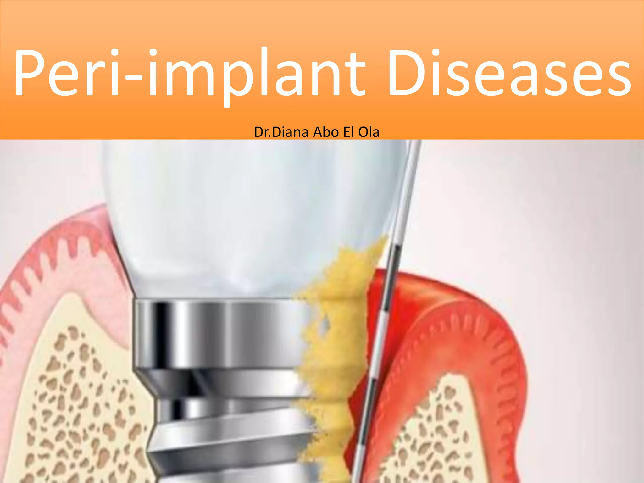 Peri-implant diseases and their treatment. | PPTX
