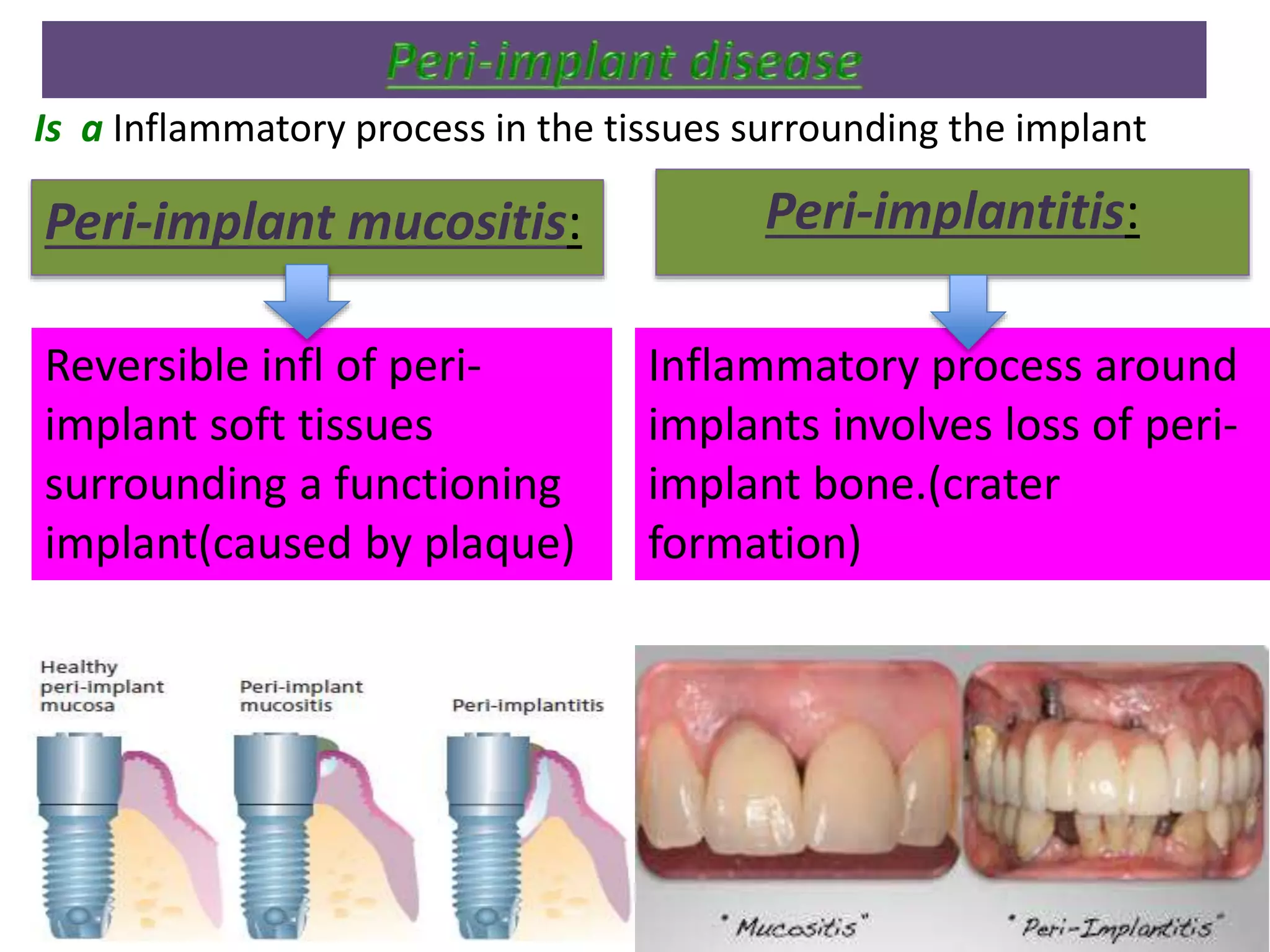 Peri-implant diseases and their treatment. | PPTX