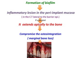 Peri-implant diseases and their treatment. | PPTX