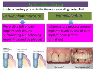 Peri-implant diseases and their treatment. | PPTX