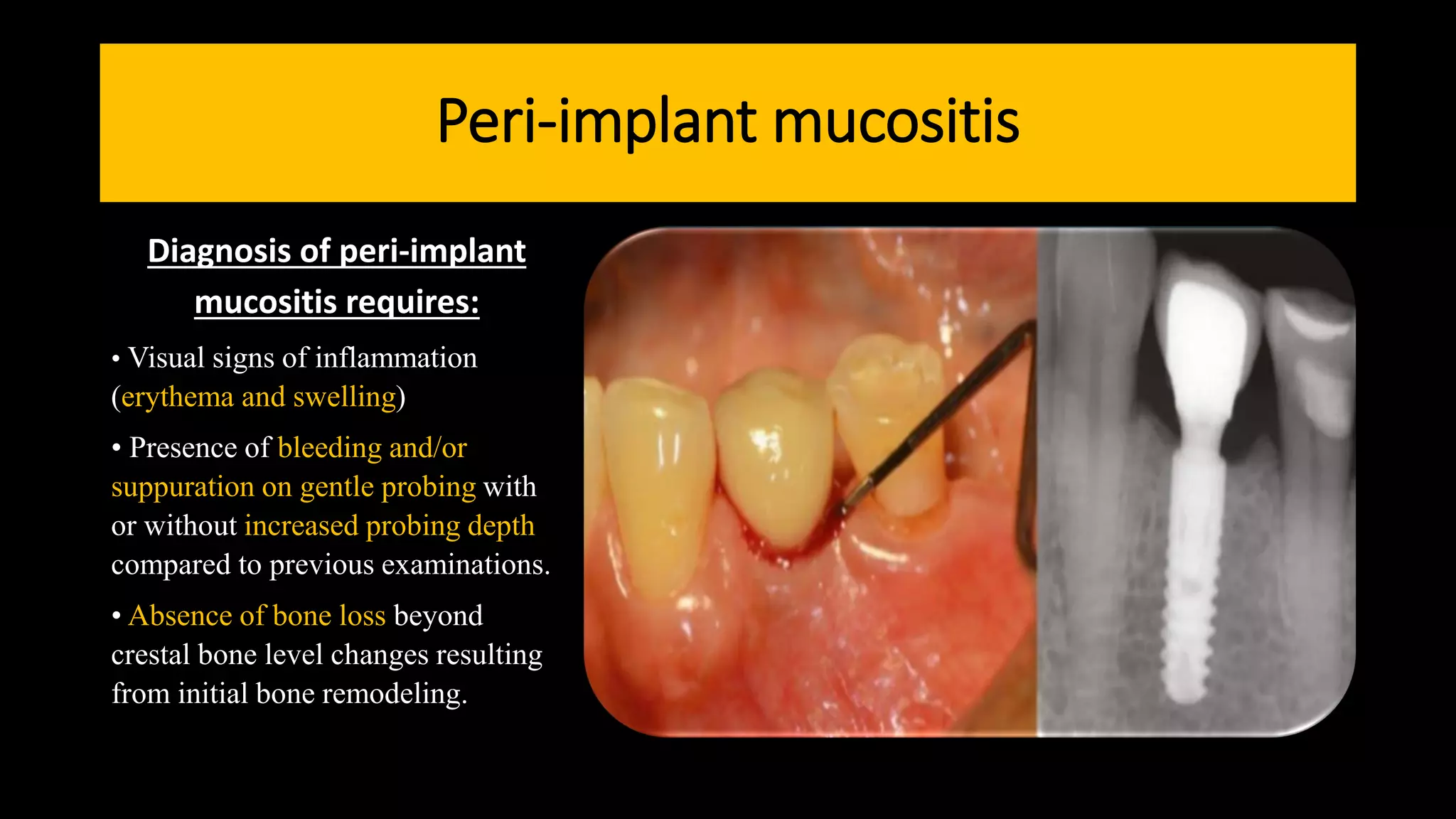 Peri-implant Diseases Classification, Cases Definition and Treatment.pdf