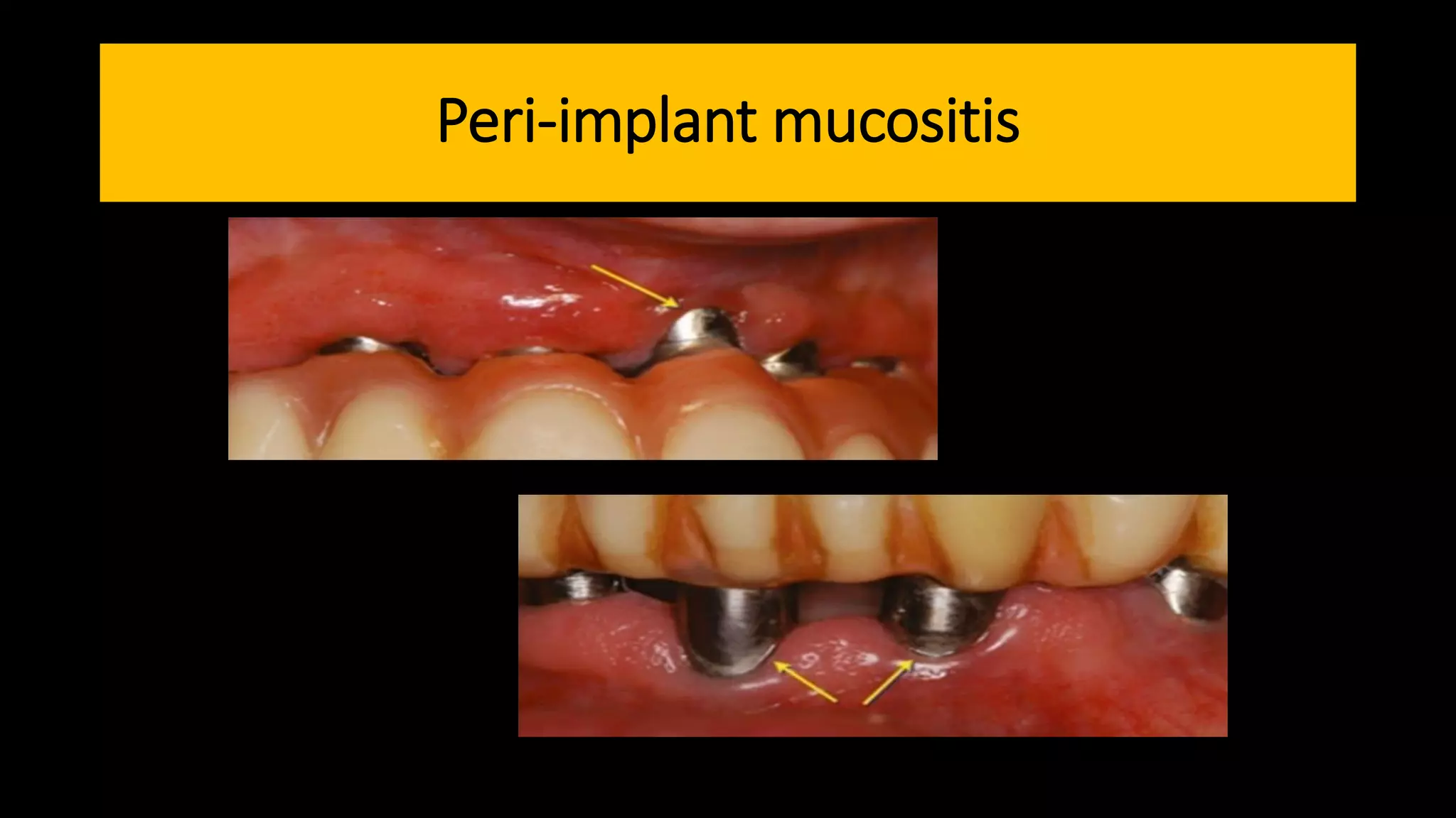 Peri-implant Diseases Classification, Cases Definition and Treatment.pdf