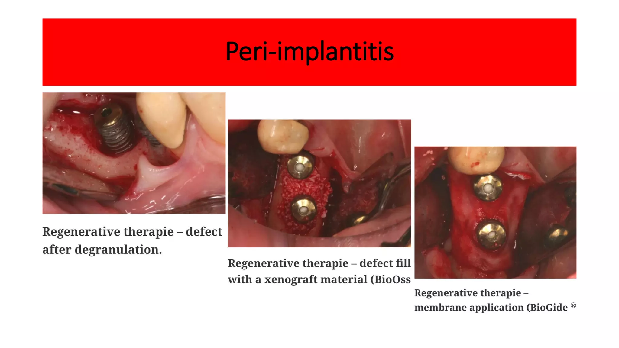 Peri-implant Diseases Classification, Cases Definition and Treatment.pdf