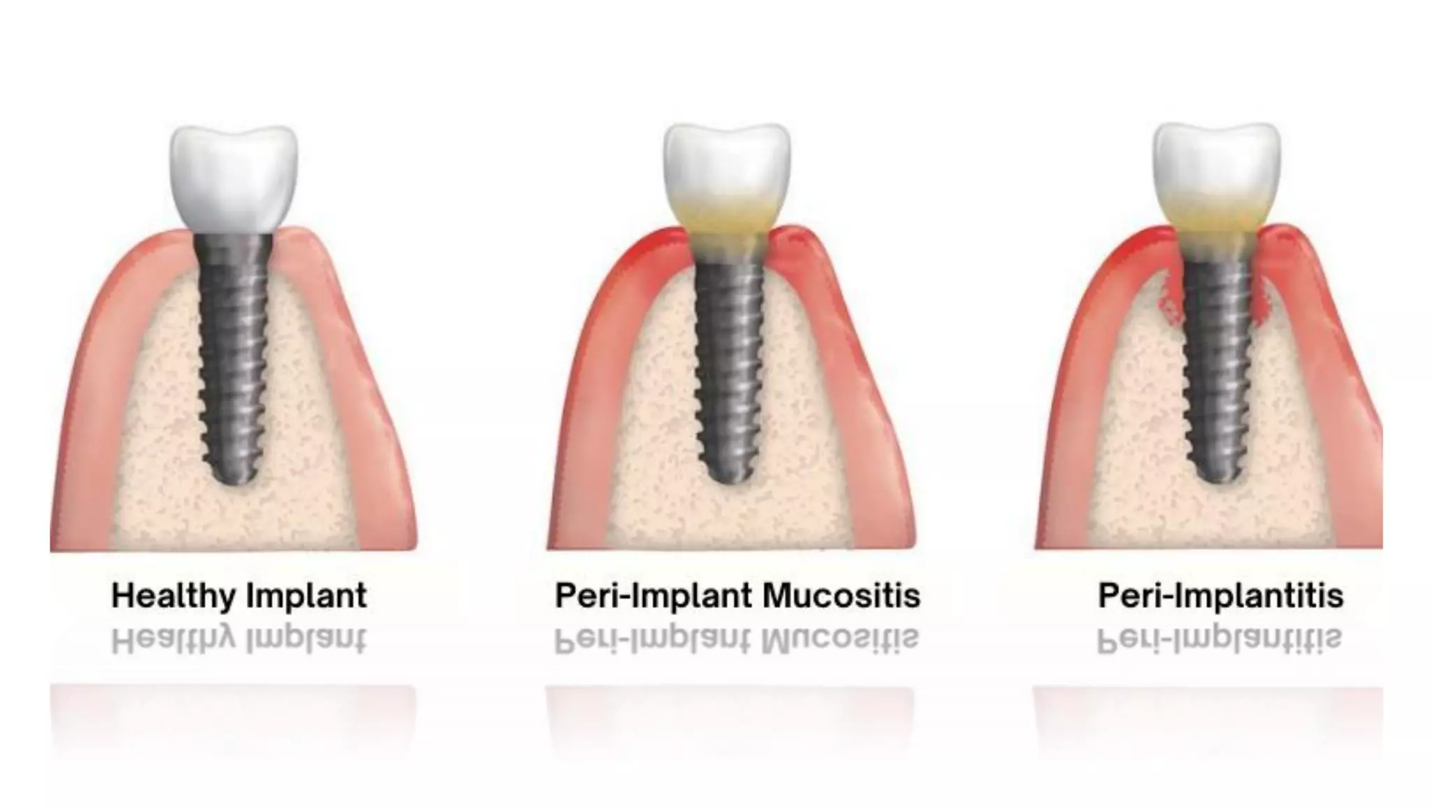 Peri-implant Diseases Classification, Cases Definition and Treatment.pdf