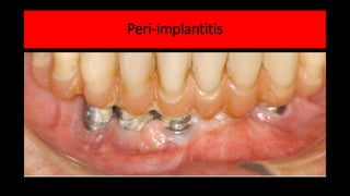 Peri-implant Diseases Classification, Cases Definition and Treatment.pdf