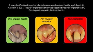 Peri-implant Diseases Classification, Cases Definition and Treatment.pdf
