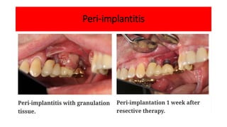 Peri-implant Diseases Classification, Cases Definition and Treatment.pdf